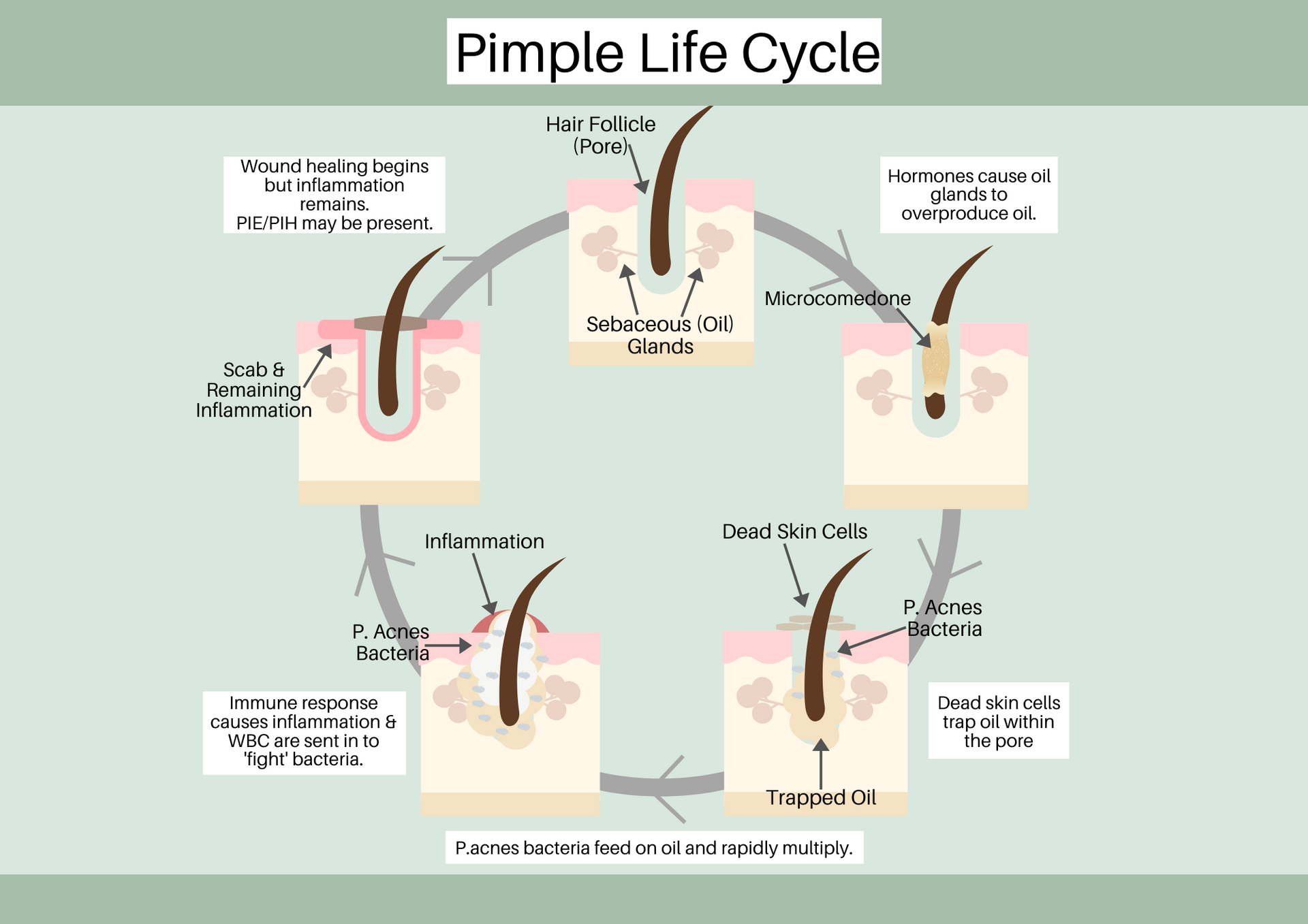 Acne: Discover the Hidden Causes Behind this Skin Condition