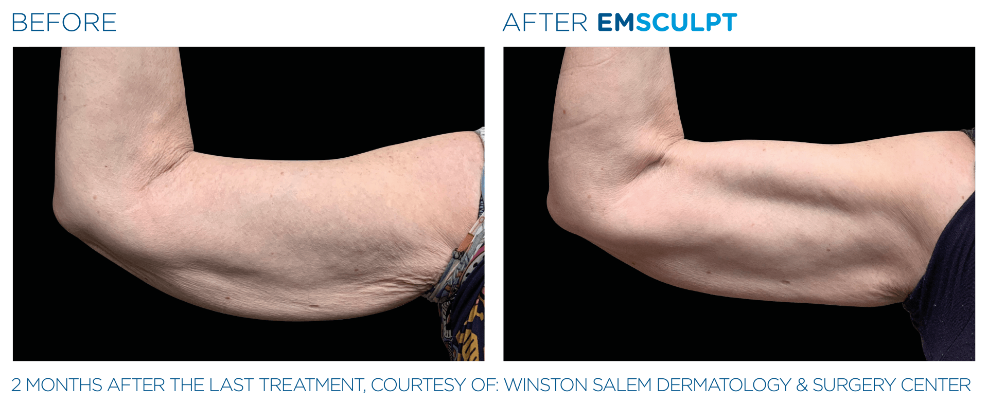 Body Sculpting by EMSCULPT | Columbus, OH | Columbus EMSCULPT