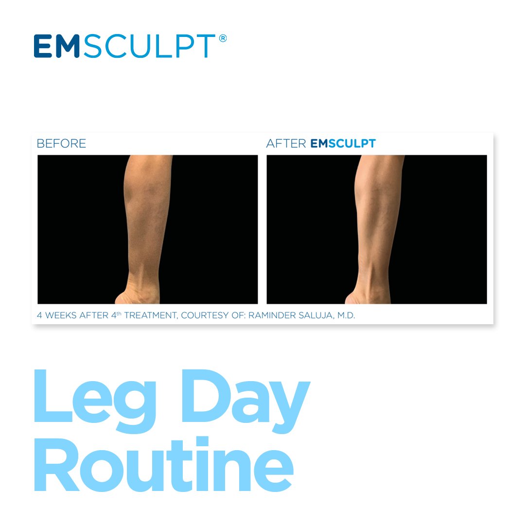 Real People, Real Results with Columbus Emsculpt Body Sculpting ...