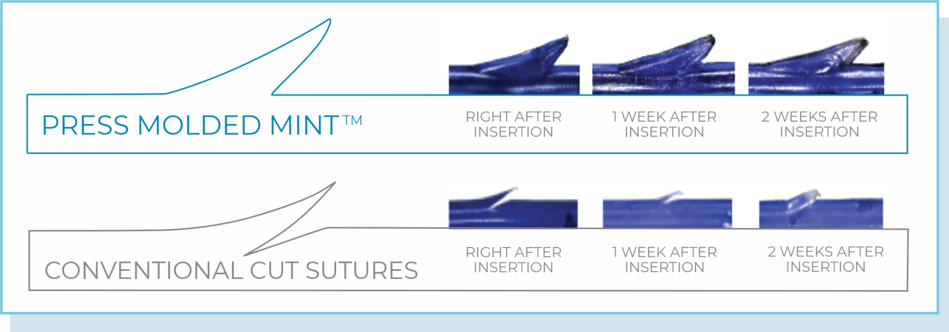 Premium Polydioxanone Threads for Non-Surgical Facelifts - MintPDO