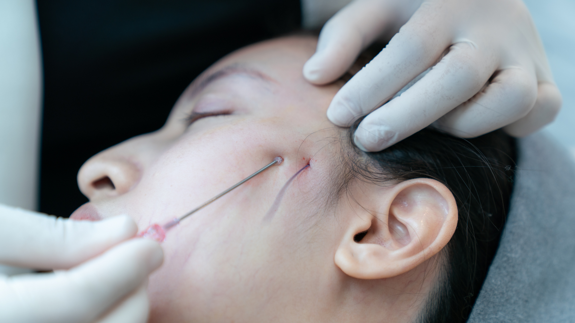 Dermal Fillers vs. PDO Thread Lifts: Which One Is Better For Me?