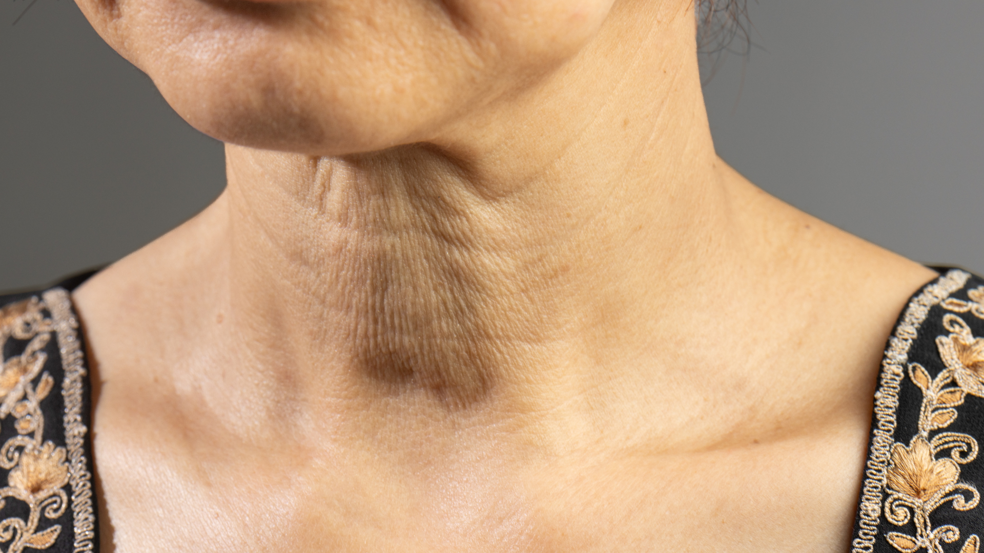 Enhance Your Neck Area with PDO Threads: A Comprehensive Guide