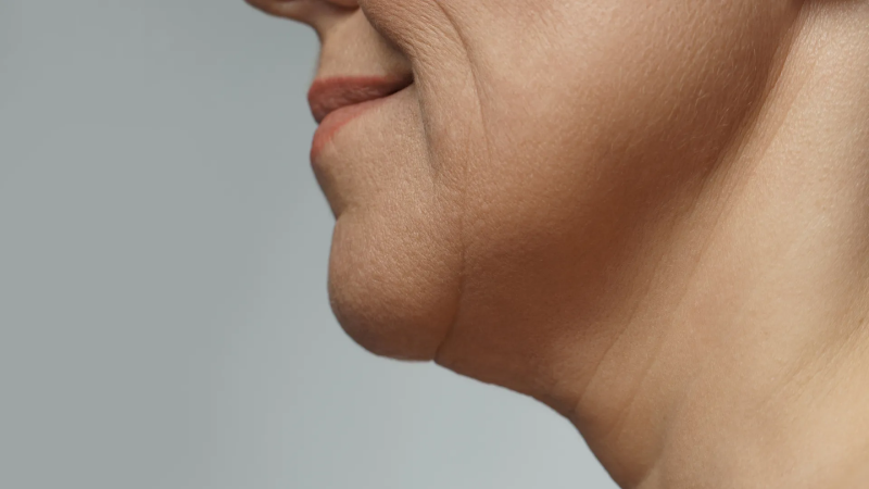 Can a PDO Thread Lift Help Your Double Chin?