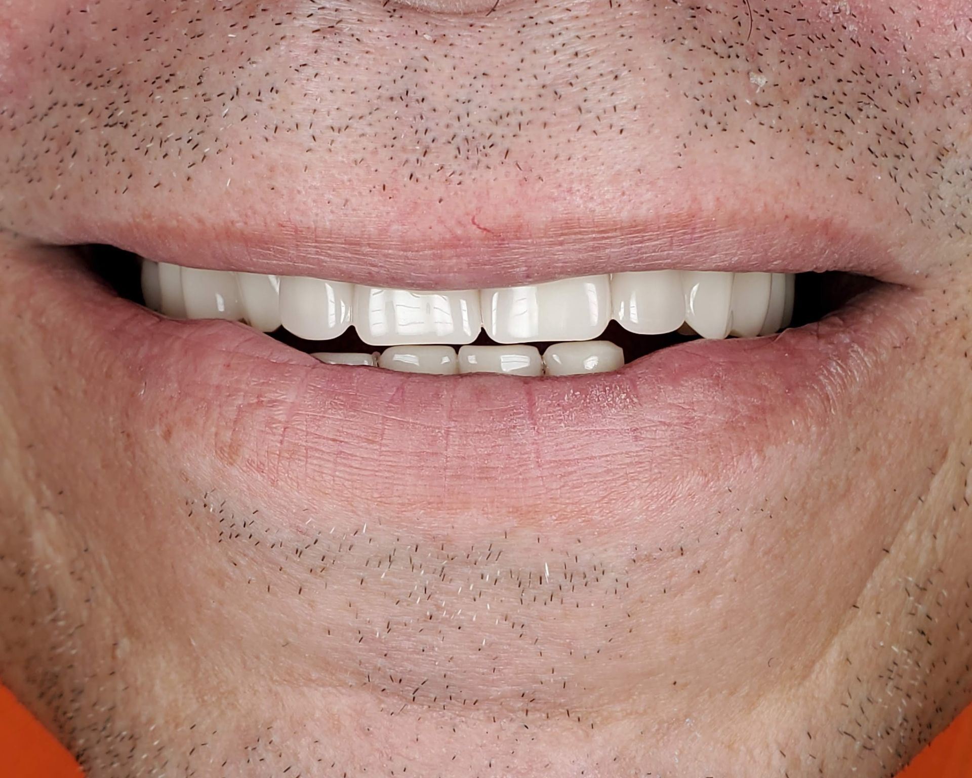 Smile Gallery | Alpine Dental