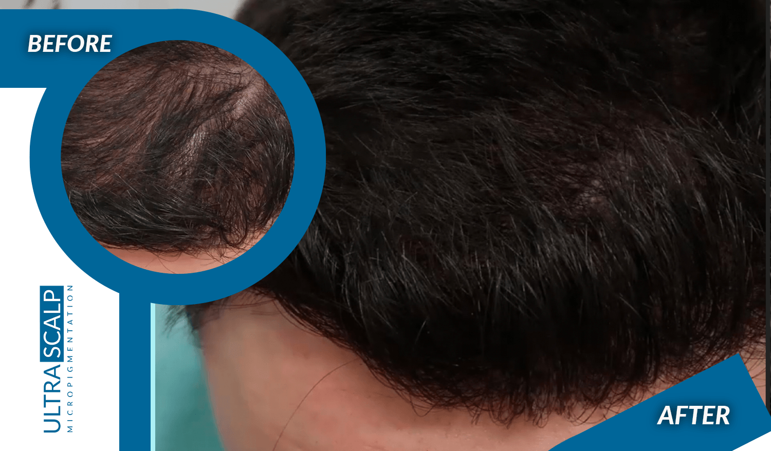 Scalp Micropigmentation For Thinning Hair Tampa