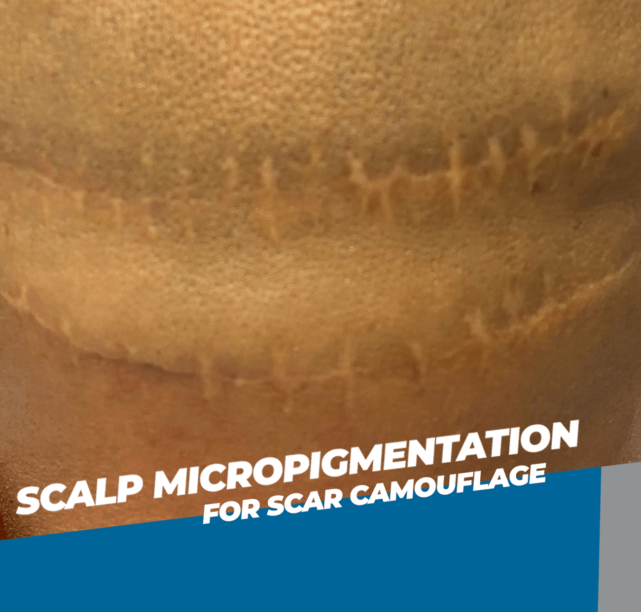 Hair Transplant Scar Cover Up Using Scalp Micropigmentation