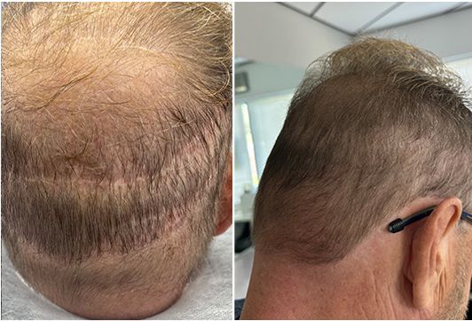 Scalp Micro Pigmentation for scars, bald spots, hair loss
