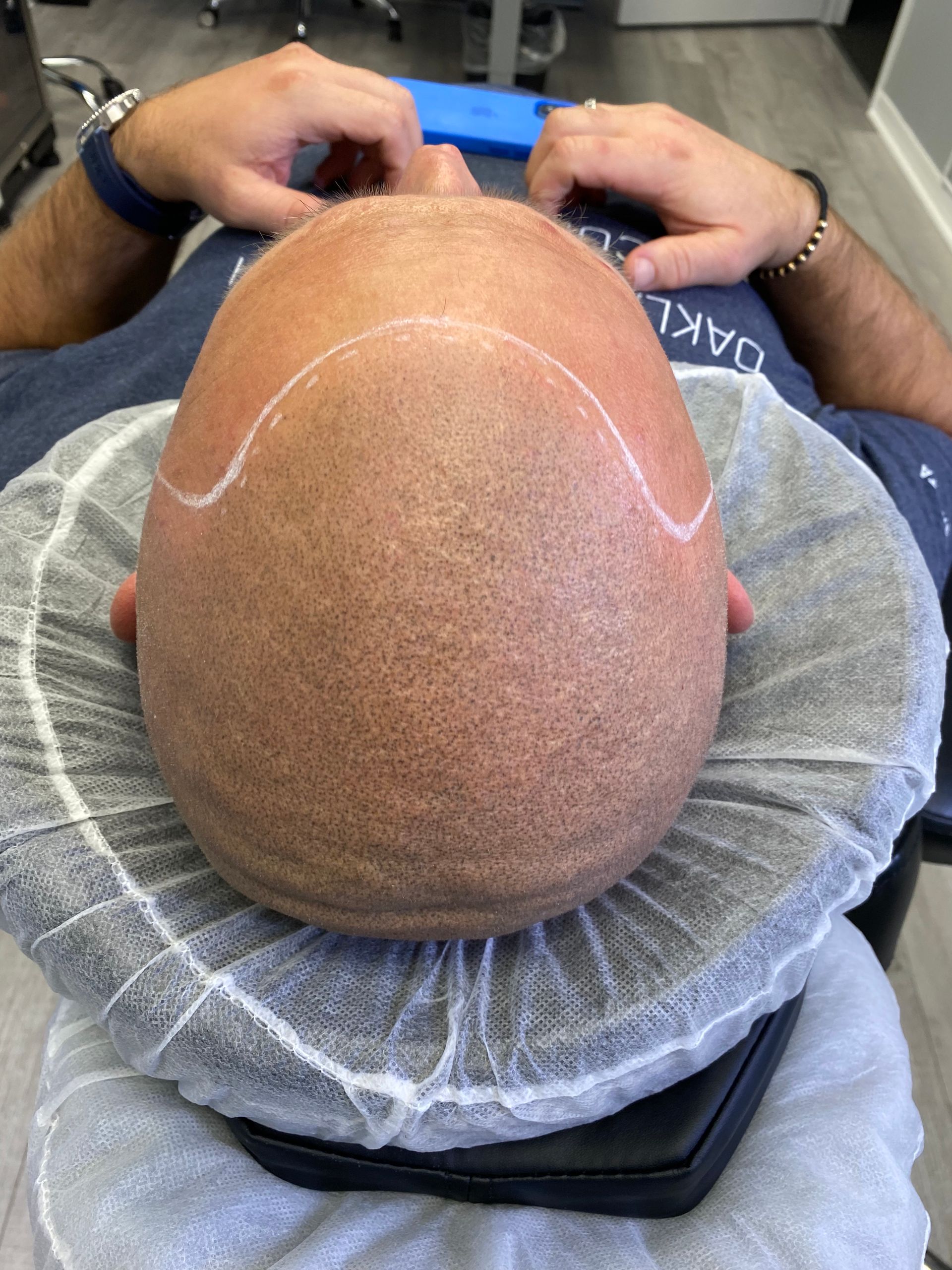 Choosing the Right Hairline for Scalp Micropigmentation