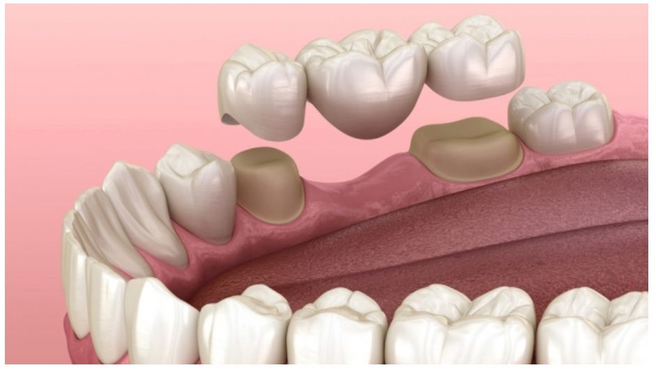 Enhancing Smiles with Dental Bridges in Orlando, FL: Procedure ...
