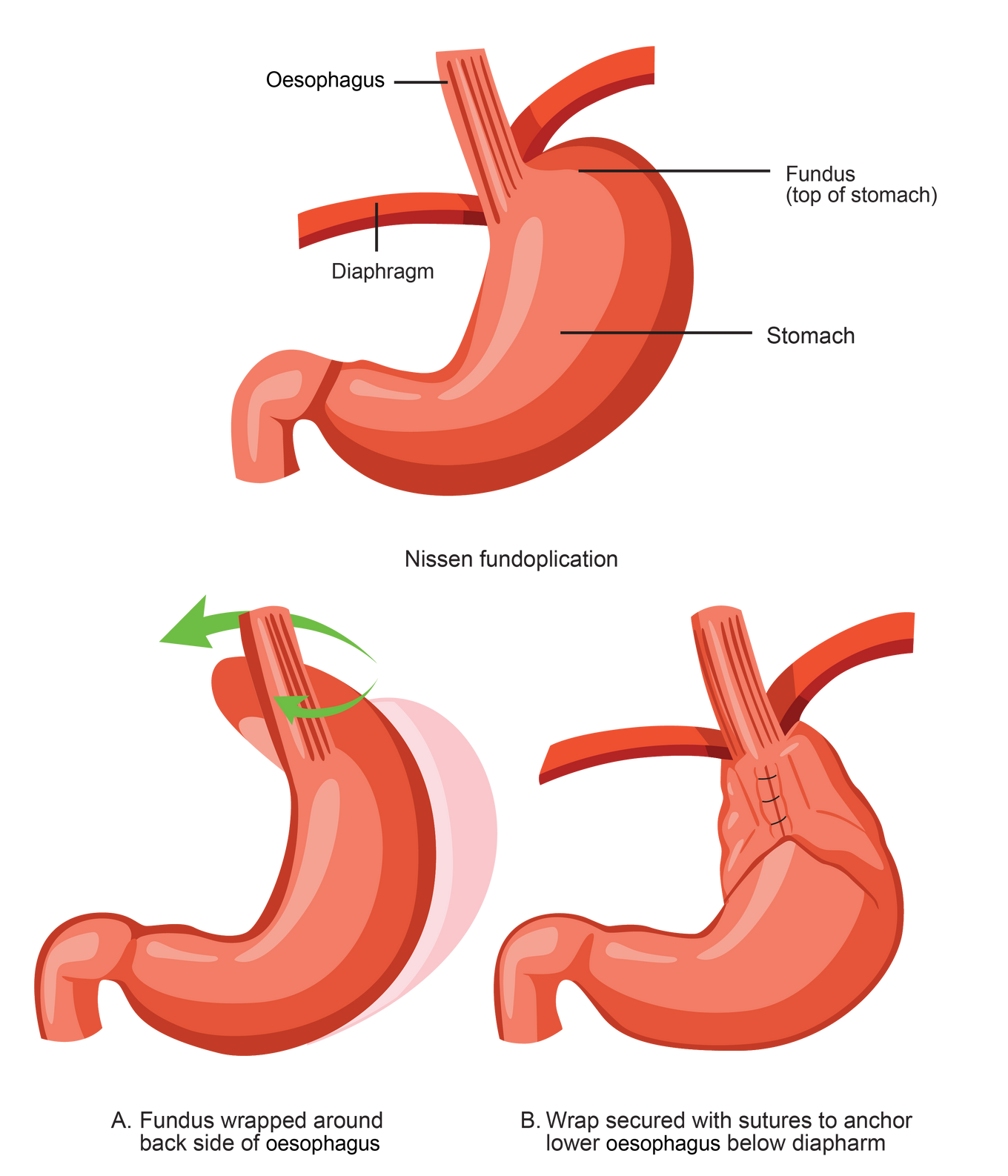 Gastric Reflux | Windsor | Moorabbin | Warragul