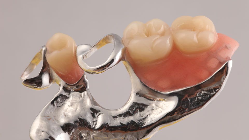 Modellgussprothese – herausnehmbare Teilprothese