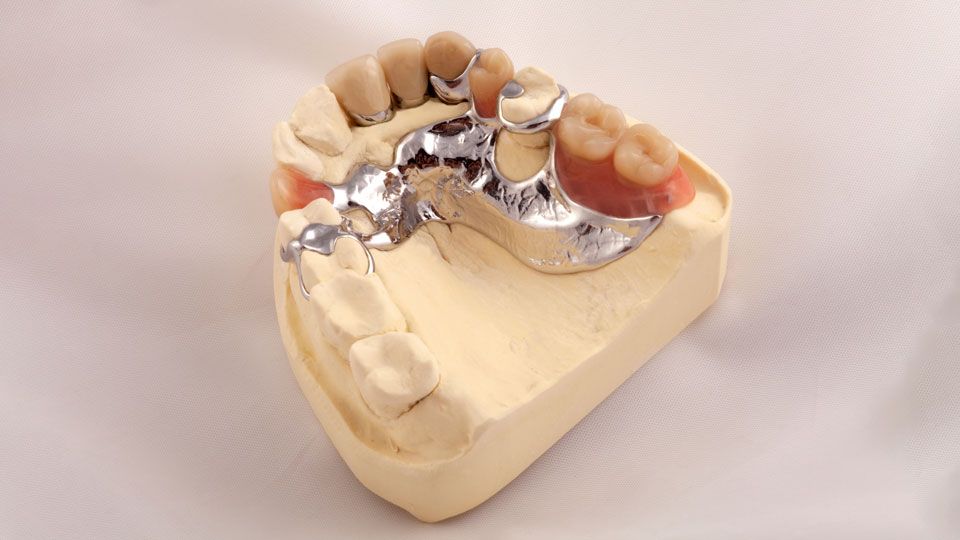 Modellgussprothese – herausnehmbare Teilprothese