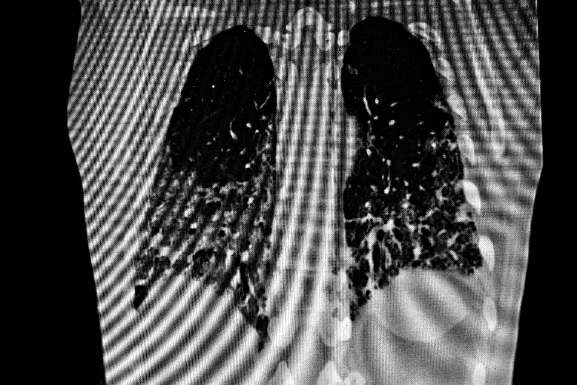 Esame polmonare | Sciacca, AG | Centro Radiologia Tagliavia