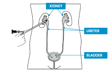 Percutaneous nephrolithotomy (PCNL)