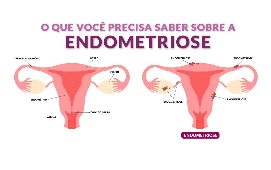 O que você precisa saber sobre endometriose