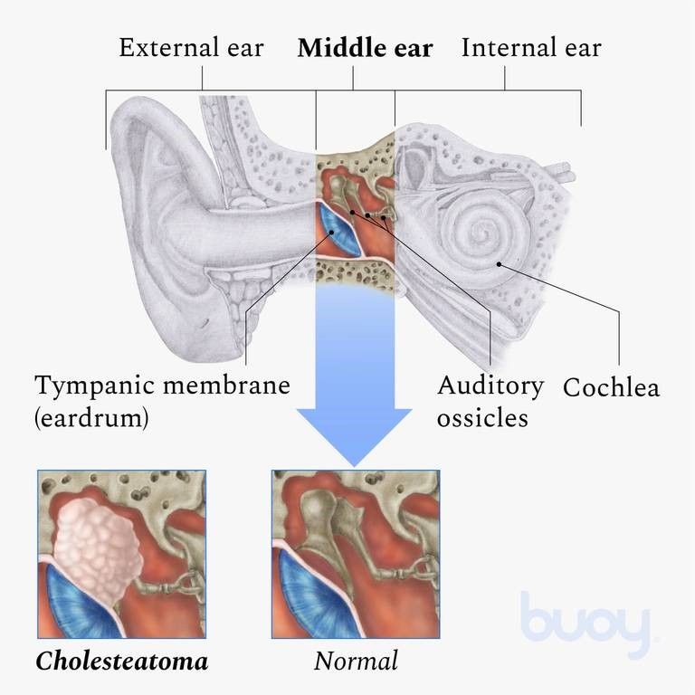 What is a Cholesteatoma in the Ear?