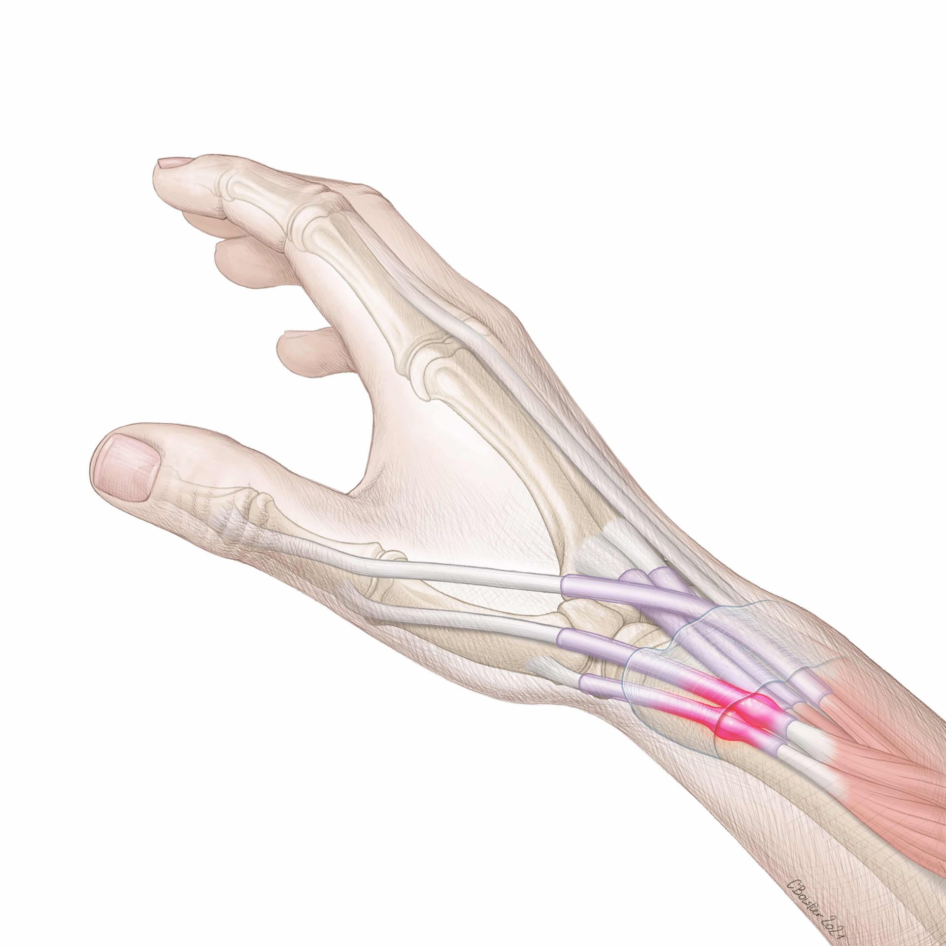 Tendinite de De Quervain : Docteur Charles Bijon à Paris