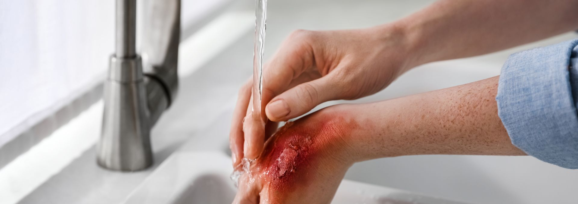 Que faire en cas de brûlure à la main