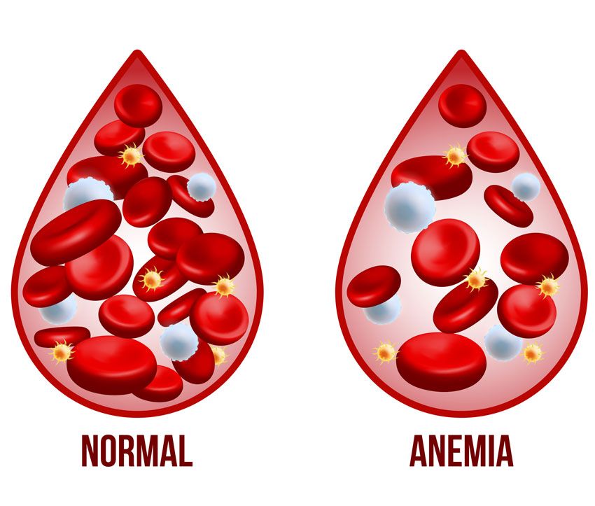 Causas más comunes de la anemia