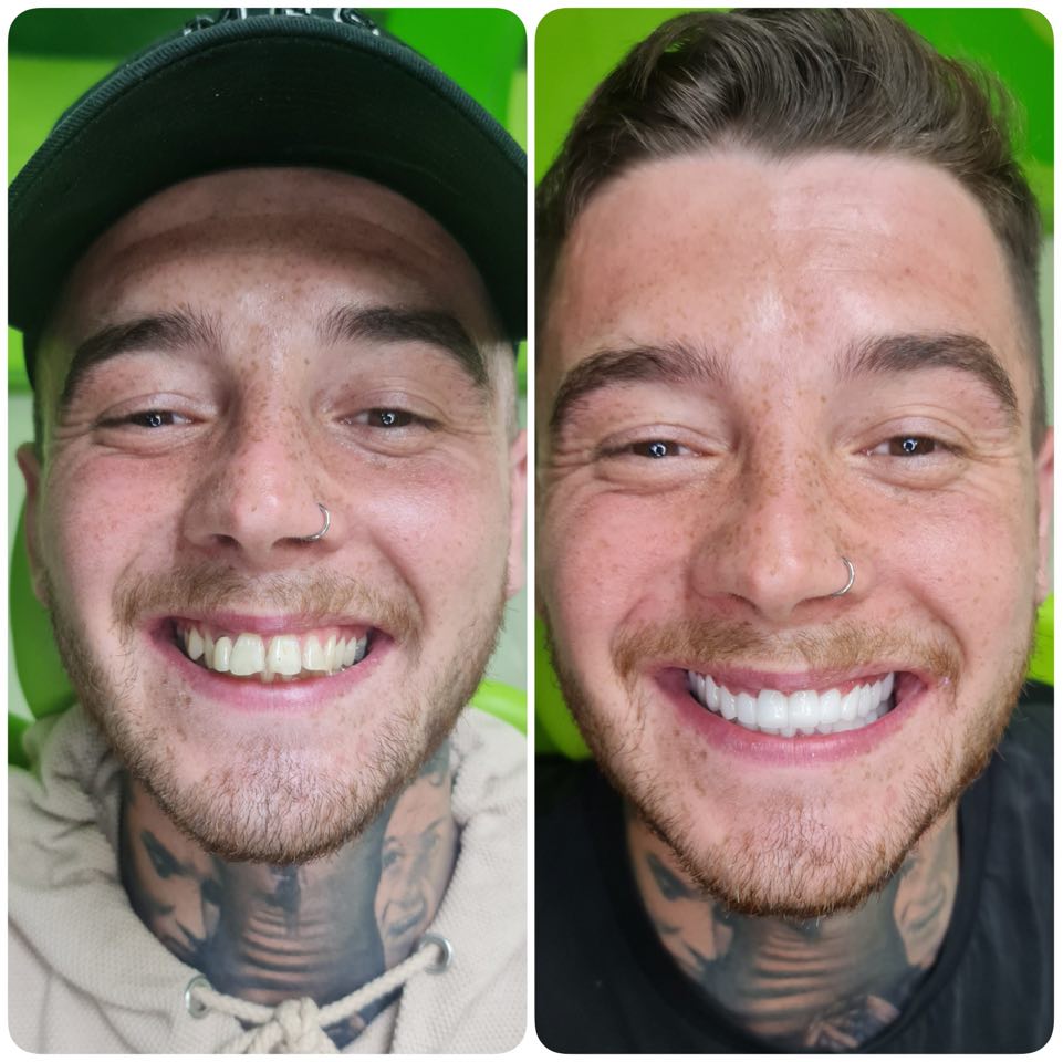 UK Smiles - #1 In Turkey Teeth Dental Treatments