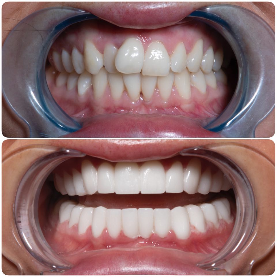 UK Smiles - #1 In Turkey Teeth Dental Treatments