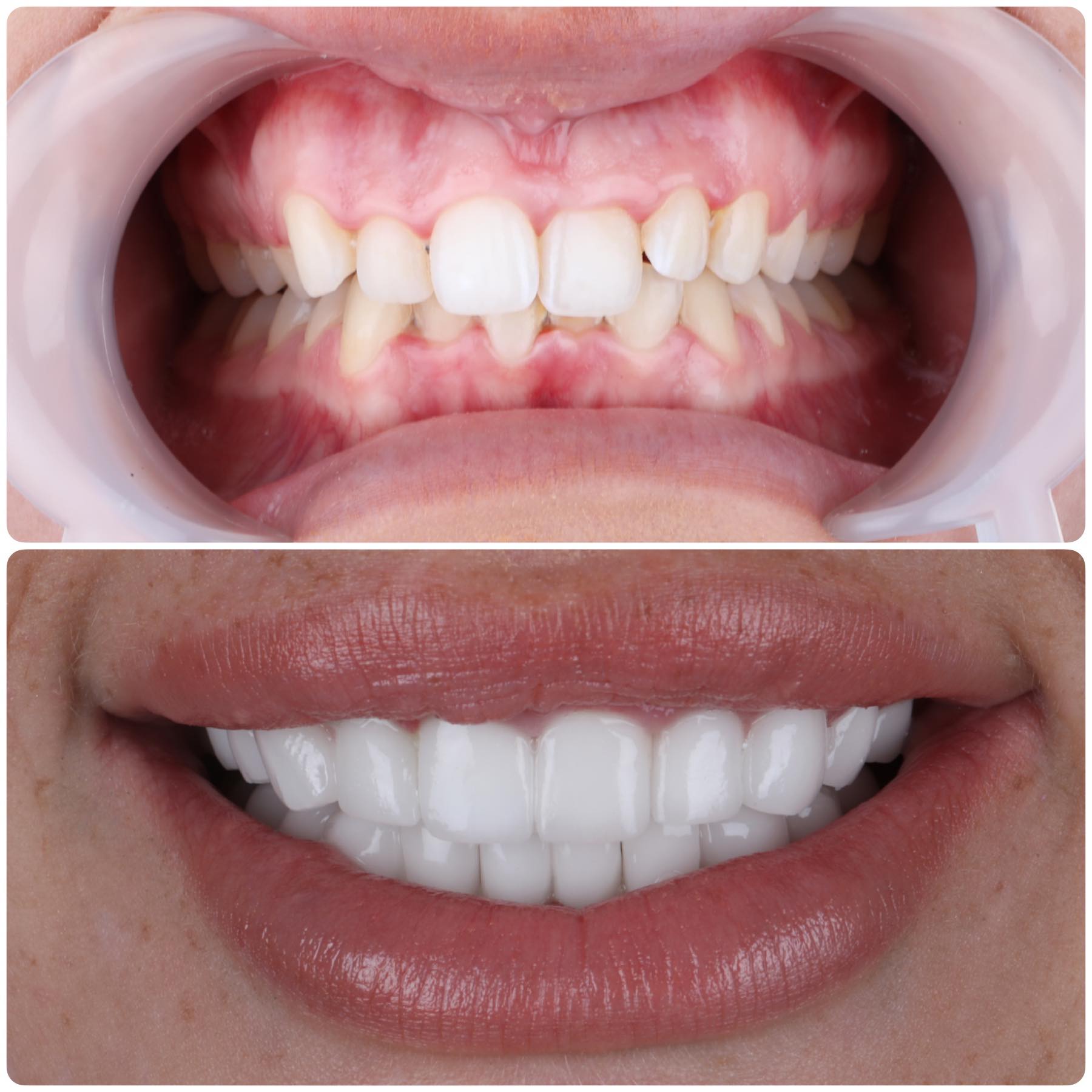 UK Smiles - #1 In Turkey Teeth Dental Treatments