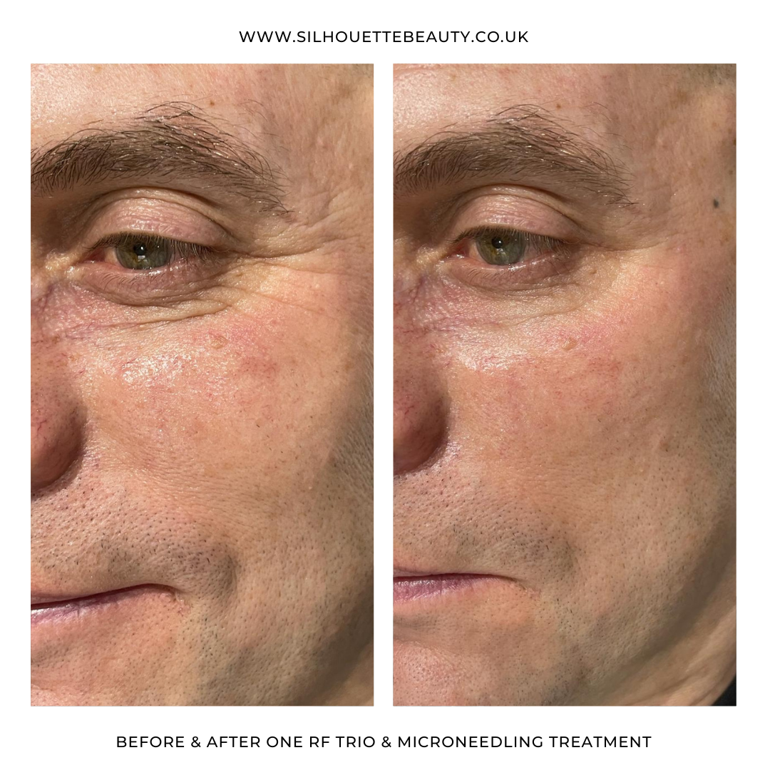 Exploring the Anti-Aging Benefits of Microneedling Facials