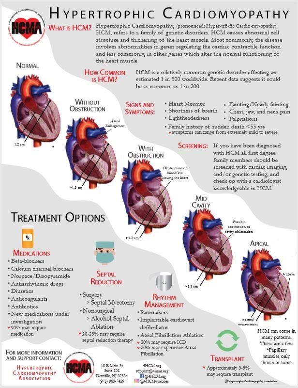 Learn when in life hypertrophic cardiomyopathy develops