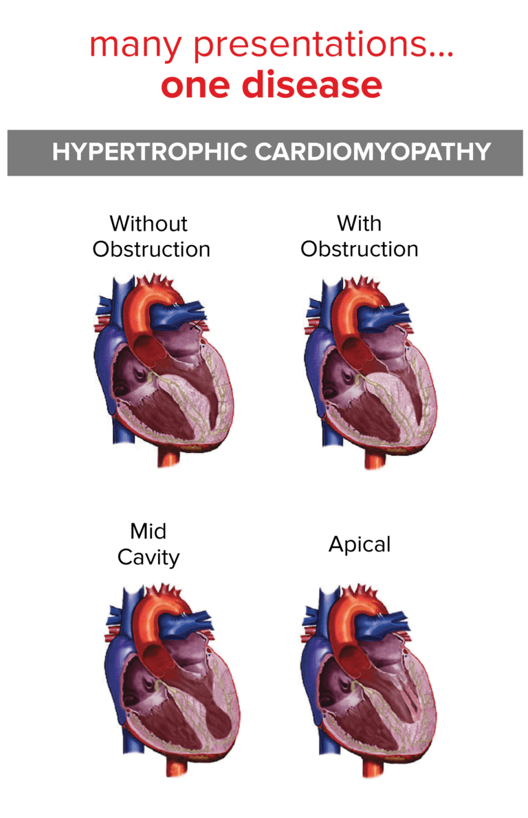 Hypertrophic cardiomyopathy makes heart muscle thick.