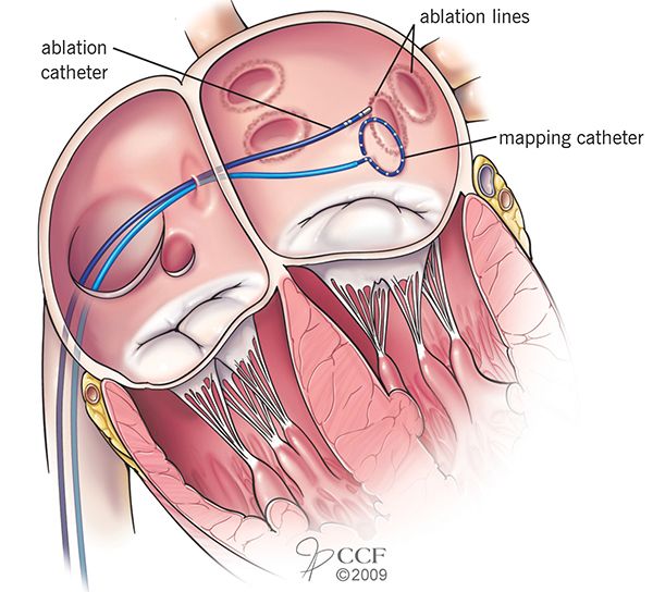 Pulmonary Vein Ablation