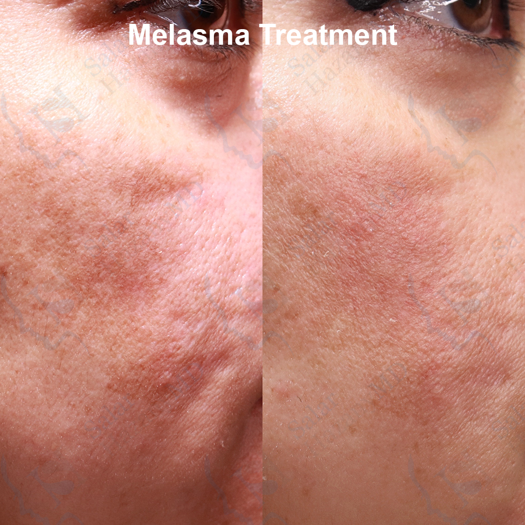 Melasma Treatment + Removal | Los Angeles | Hazany MD