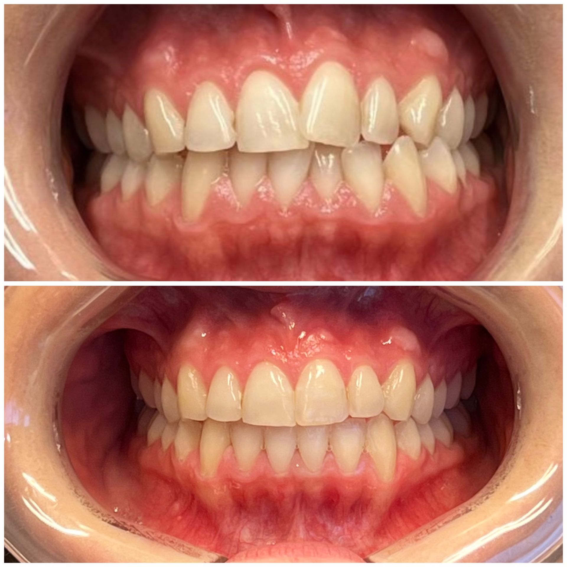 Invisalign før og etter | Resultater 2024| Moderne tannbehandling