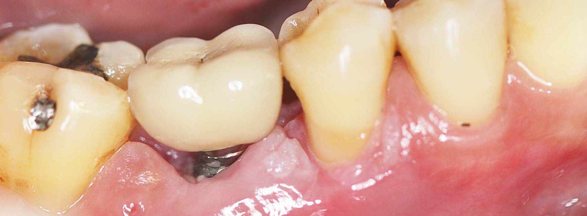 LAPIP Treatments for Peri-Implantitis - Dr. Stephanie Sfiroudis