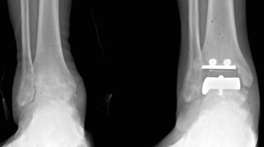 Ankle Joint Replacement | Align Orthopaedics | South Brisbane