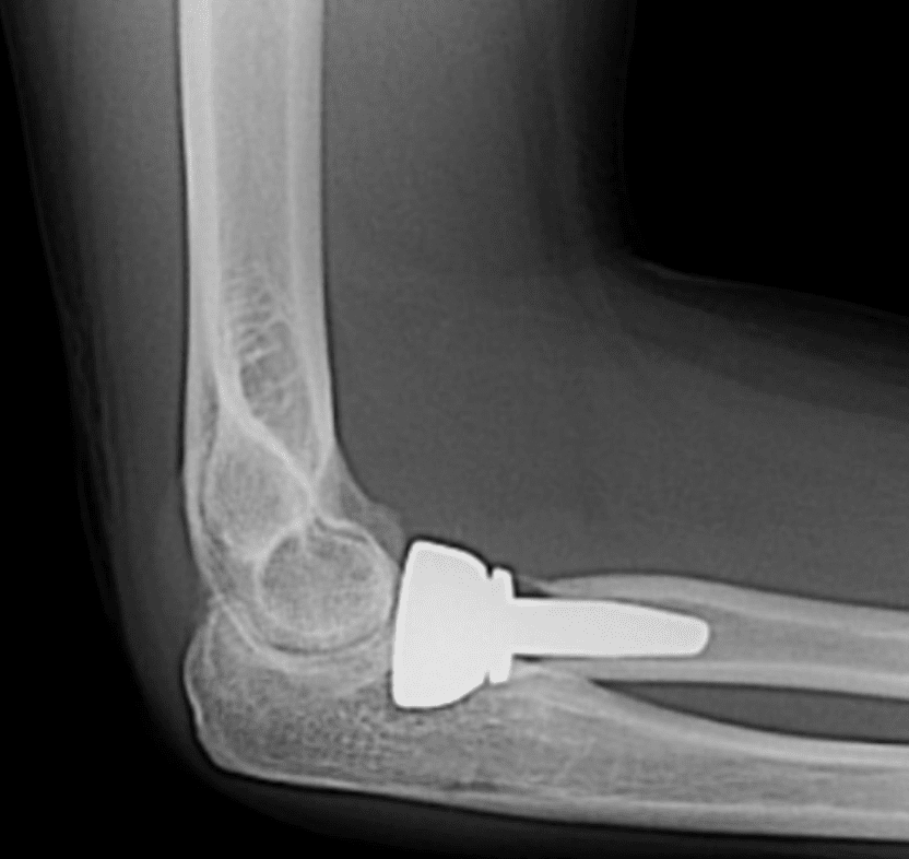 Elbow Replacement | Align Orthopaedics | South Brisbane