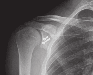 Shoulder Reconstruction | Align Orthopaedic Surgeons, South Brisbane