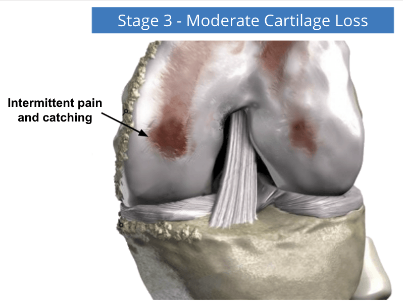 Knee Arthritis | Align Orthopaedics | South Brisbane