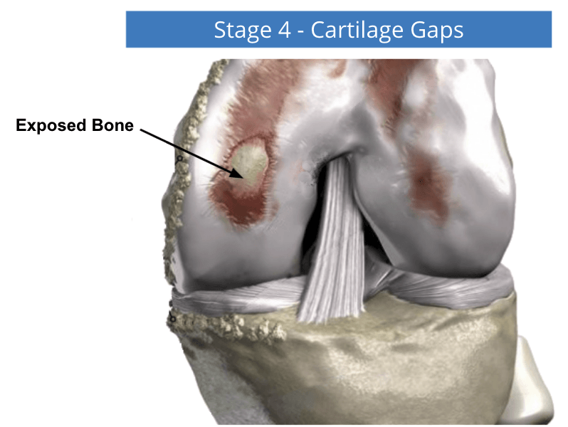 Knee Arthritis | Align Orthopaedics | South Brisbane