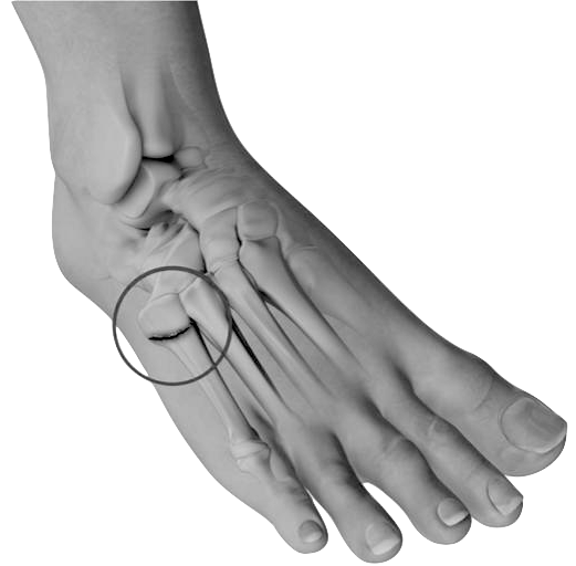 Toe & Forefoot Fractures | Align Orthopaedics + Rehab, Orthopaedic ...
