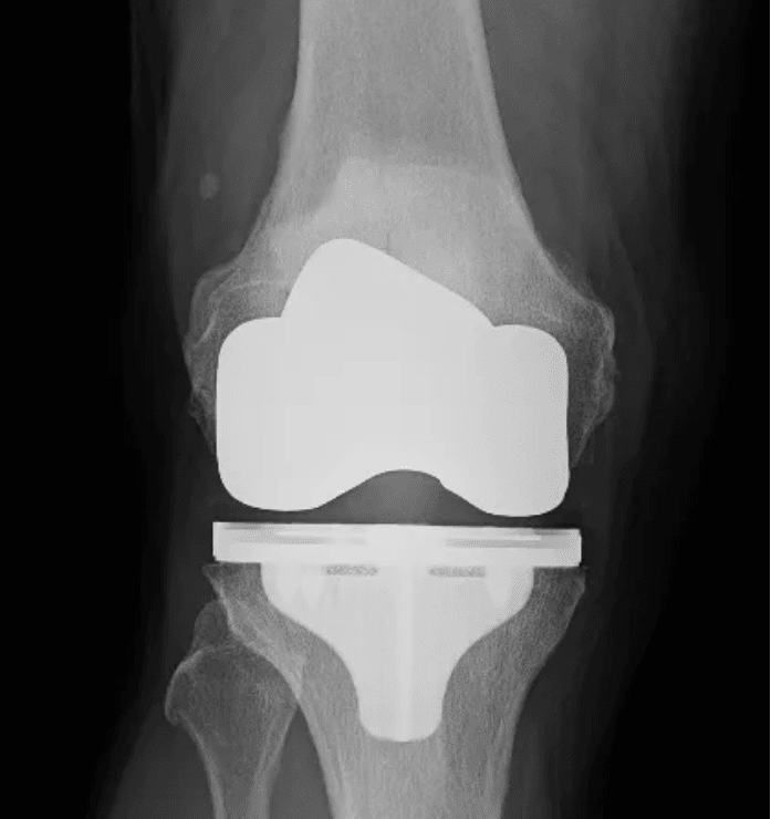 Knee Replacement | Align Orthopaedics | South Brisbane