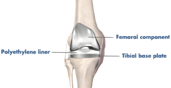 Knee Replacement | Align Orthopaedics | South Brisbane