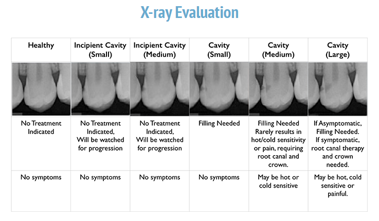 Why It's Important to Fix a Cavity When It Is Small