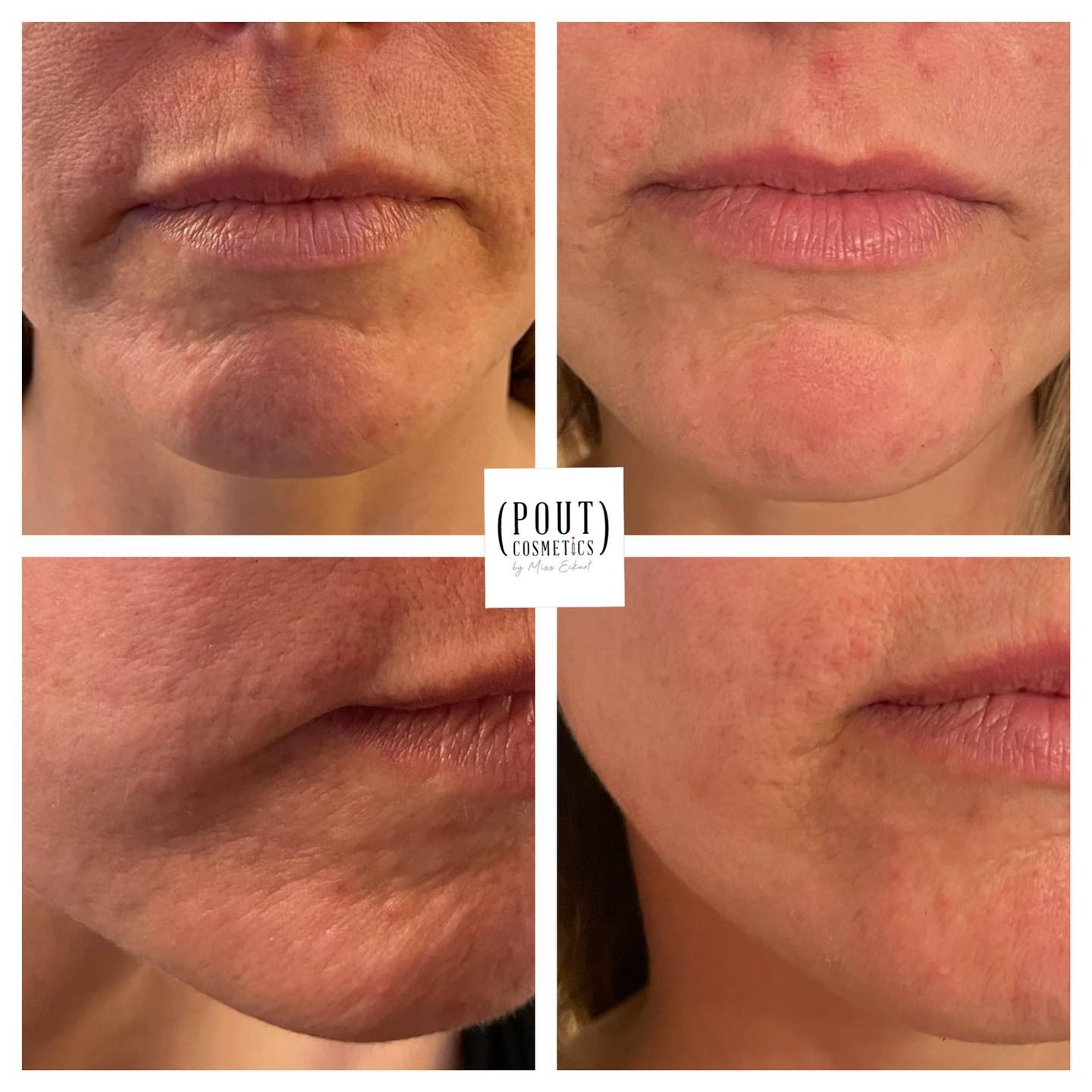 Profhilo York | Profhilo At Loves Hair & Beauty