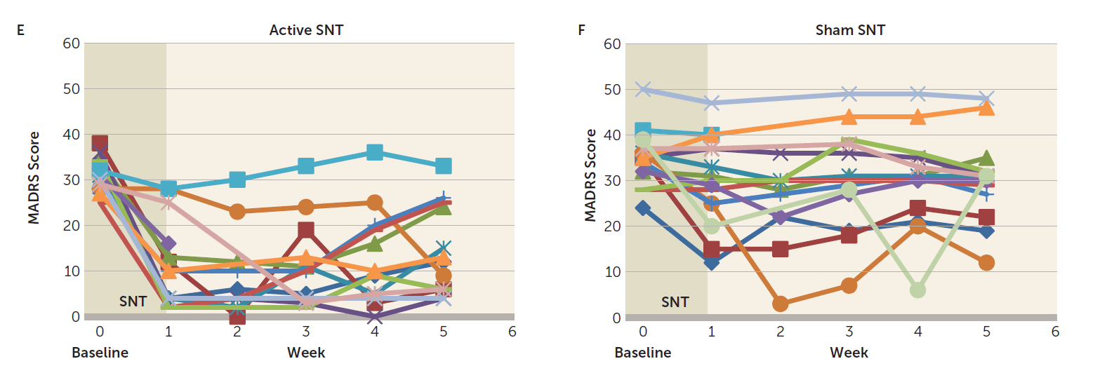 SAINT TMS | FDA Cleared Accelerated TMS Protocol