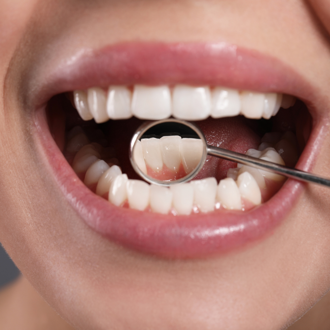 Oral Cancer Screening