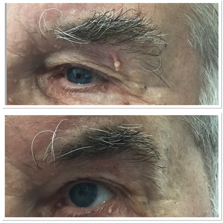 Skin Tag Removal | Epilation Services Wetherby | Revekka Treatments