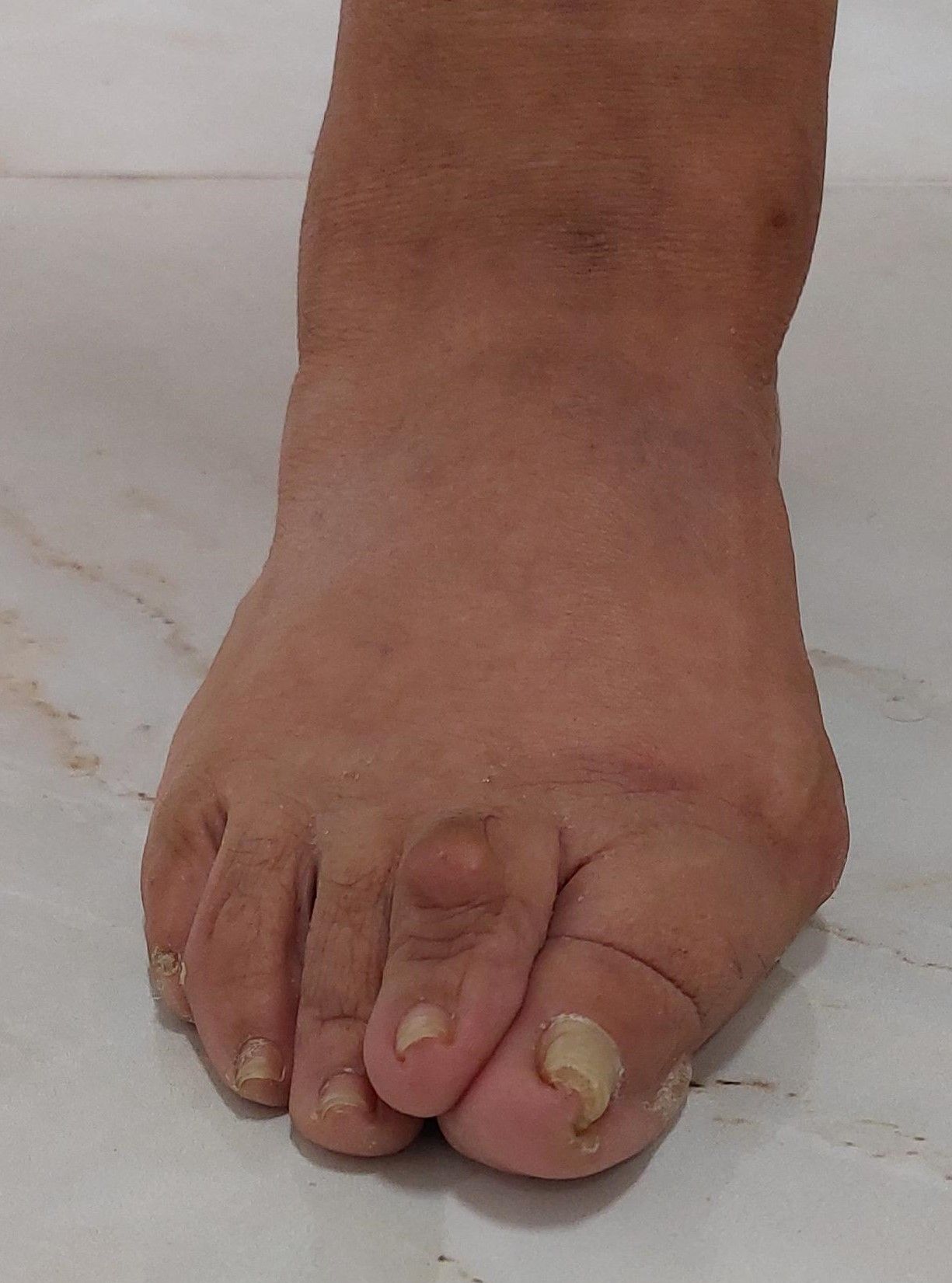 Joanete e Hálux Valgo: Tudo o que Você Precisa Saber