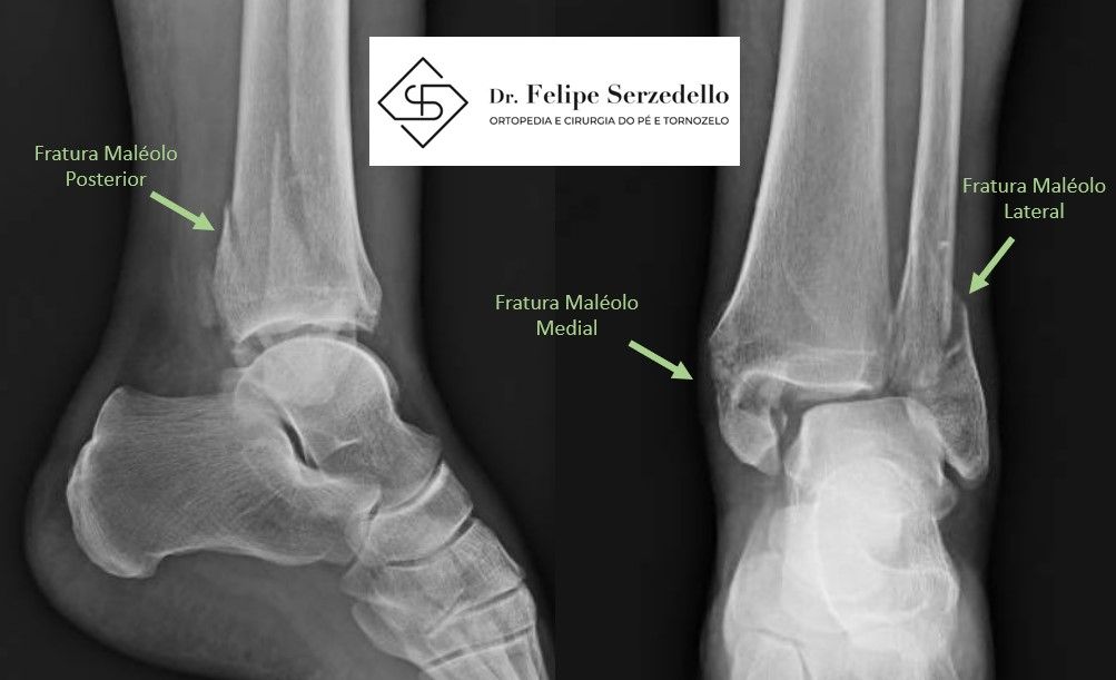Fratura de Tornozelo: tudo o que você precisa saber