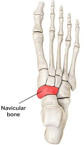 Navicular Acessório: Entenda a Dor no Pé e Como Tratar