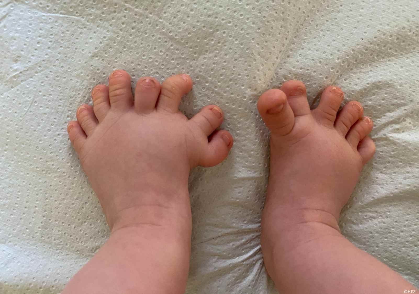 Polydaktylie – Diagnose und Behandlung im HFZ Berlin